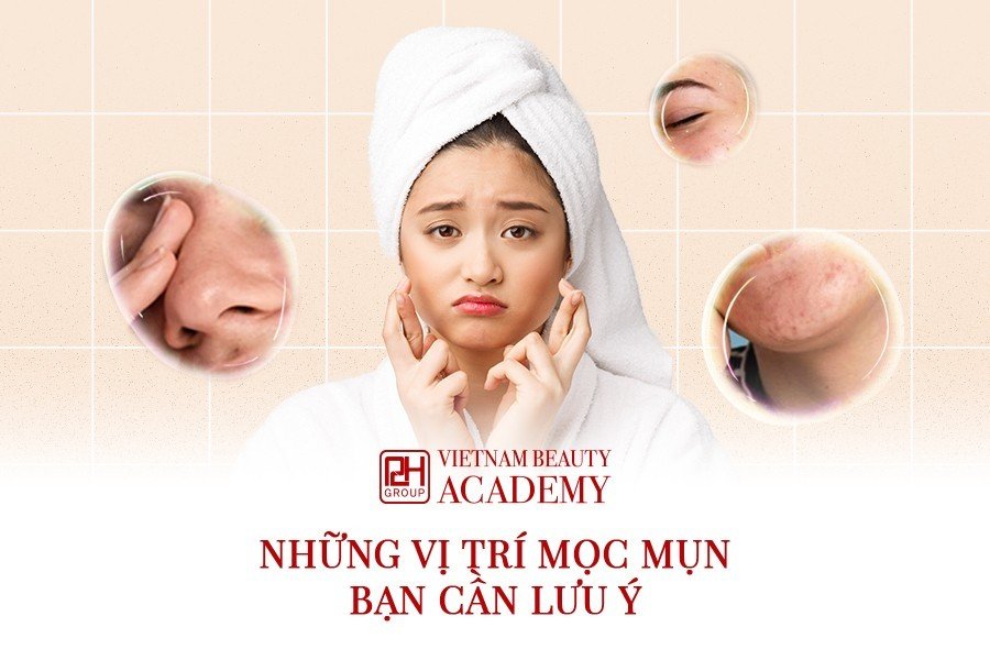 NHỮNG VỊ TRÍ MỌC MỤN BẠN CẦN LƯU Ý